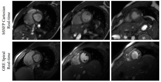 Free-Breathing and Ungated Cardiac MRI Reconstruction Using a Deep ...