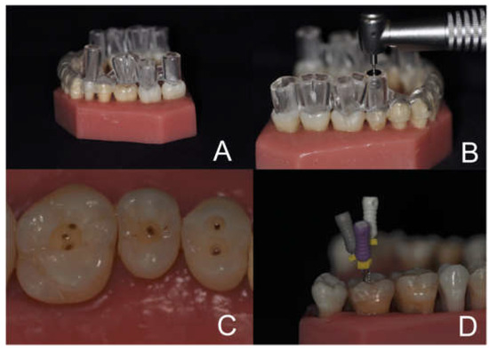 Accuracy of Guided Endodontics in Posterior Teeth