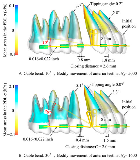 Biomechanical Analysis of Extraction Space Closure with Various Loop ...