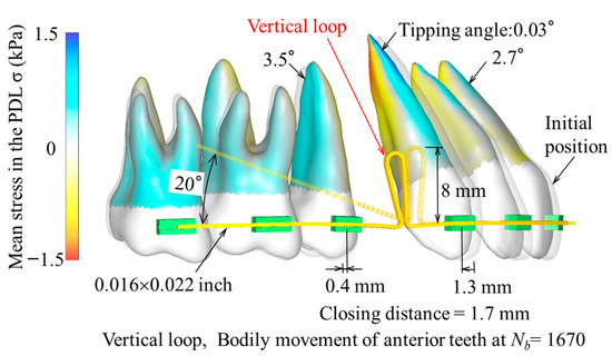 Biomechanical Analysis of Extraction Space Closure with Various Loop ...