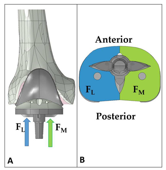 Biomechanical Analysis of Femoral Stem Features in Hinged Revision TKA ...