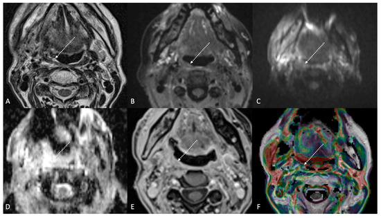 Magnetic Resonance with Diffusion and Dynamic Perfusion-Weighted ...