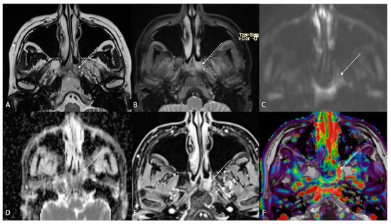 Magnetic Resonance with Diffusion and Dynamic Perfusion-Weighted ...