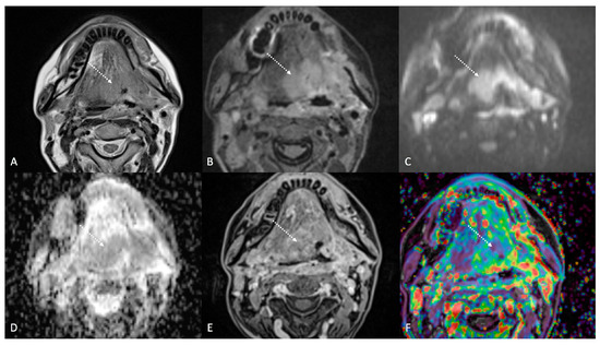 Magnetic Resonance with Diffusion and Dynamic Perfusion-Weighted ...