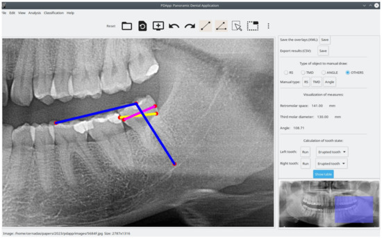 Validation Analysis of Panoramic Dental Application (PDApp) Software as ...