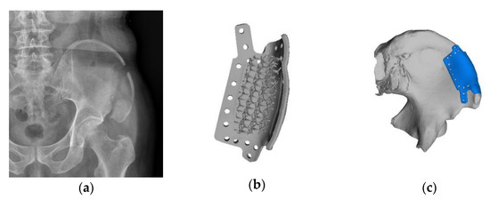 Fixation of Iliac Avulsion Fracture Using Additive Manufacturing ...