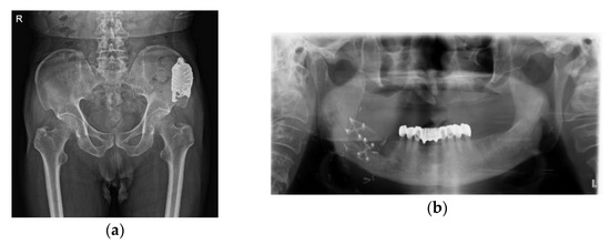 Fixation of Iliac Avulsion Fracture Using Additive Manufacturing ...