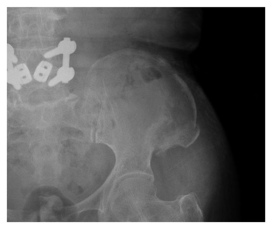 Fixation of Iliac Avulsion Fracture Using Additive Manufacturing ...