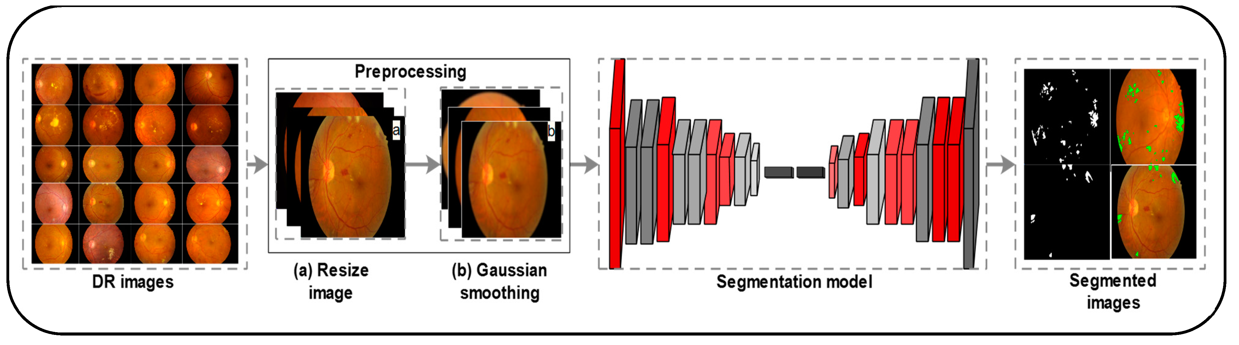 Classification and Segmentation of Diabetic Retinopathy: A Systemic Review
