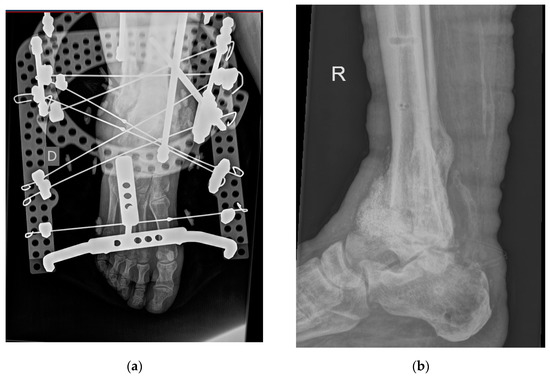 Preservation Surgery of Septic Osteoarthritis and Osteomyelitis in the ...