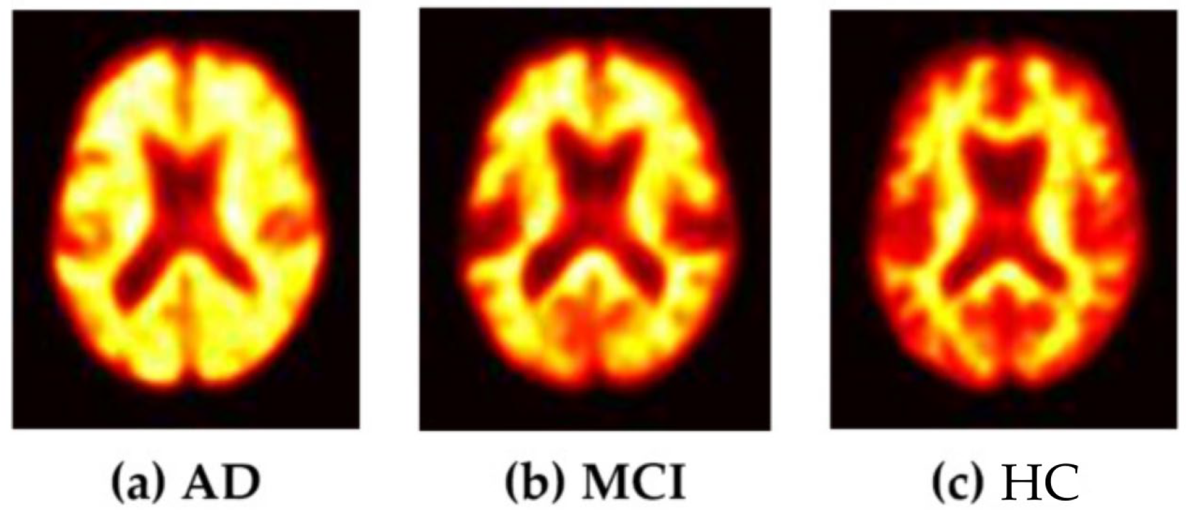Vision Transformer Approach for Classification of Alzheimer’s Disease ...