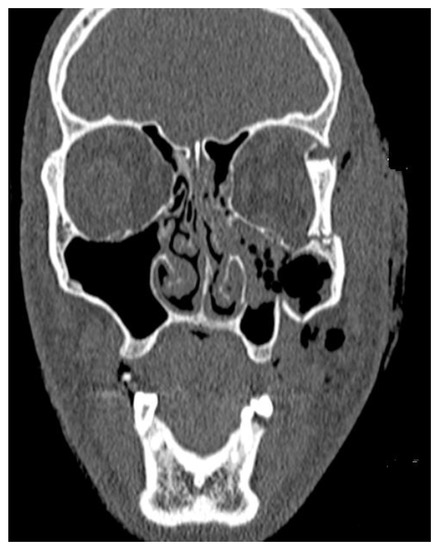 Prophylactic Coronoidectomy Approach during Stable Bone Osteosynthesis ...