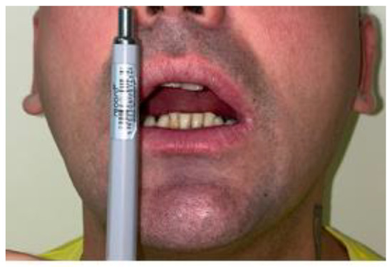 Prophylactic Coronoidectomy Approach during Stable Bone Osteosynthesis ...