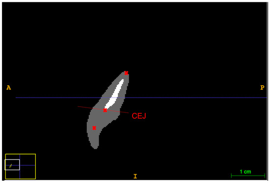 Three-Dimensional Pulp Volume Analysis in Lip and Palate Cleft Population
