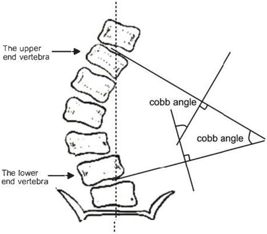 Vertebral Center Points Locating and Cobb Angle Measurement Based on Deep Learning