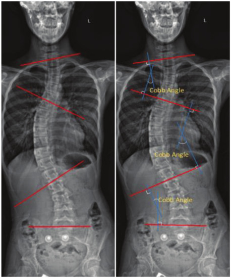 Vertebral Center Points Locating and Cobb Angle Measurement Based on ...
