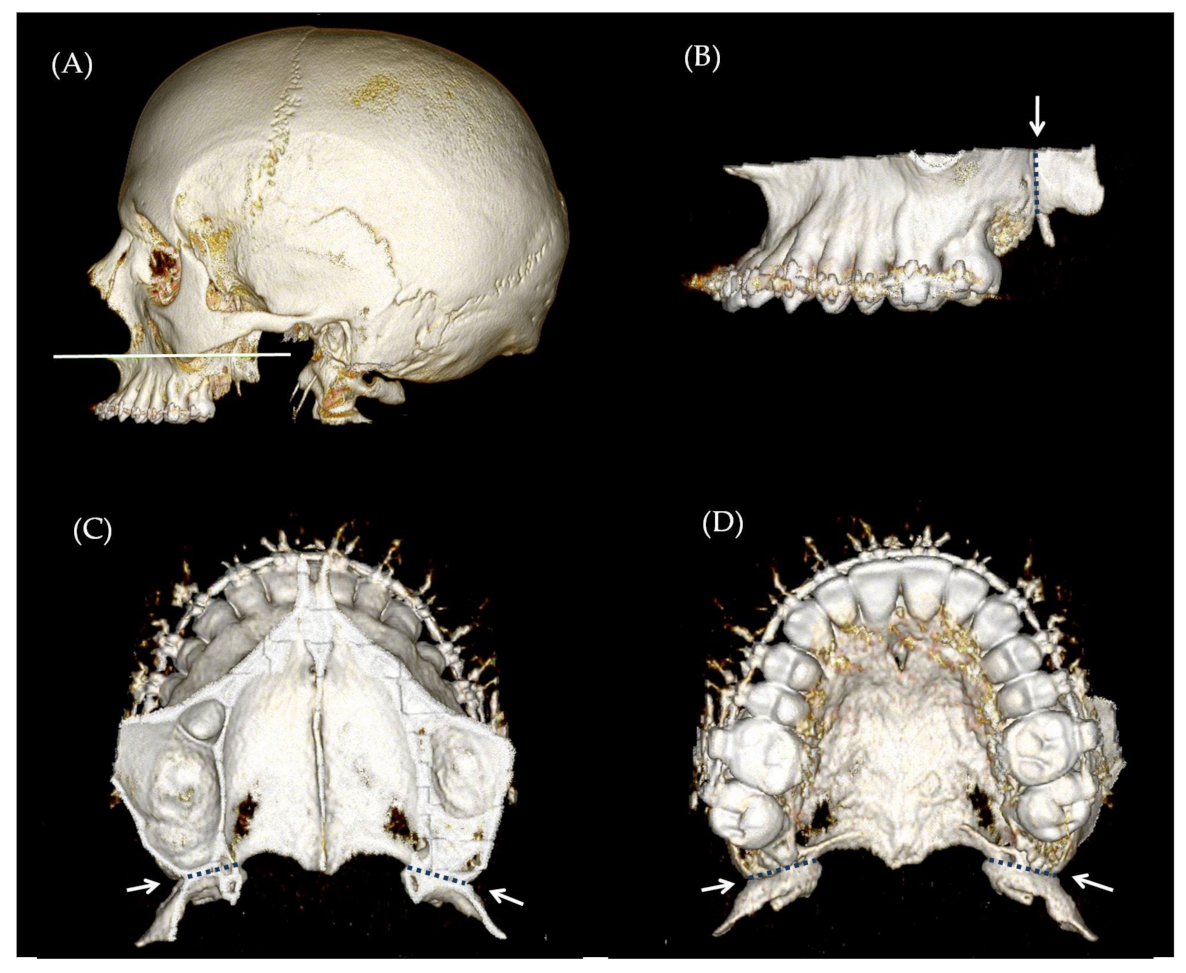 Characterization of Pterygomaxillary Suture Morphology: A CBCT Study