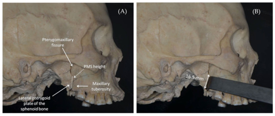 Characterization of Pterygomaxillary Suture Morphology: A CBCT Study