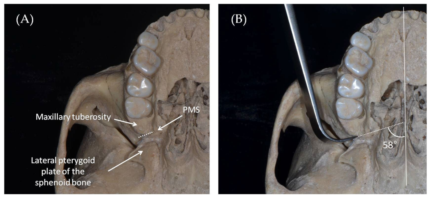 Characterization of Pterygomaxillary Suture Morphology: A CBCT Study