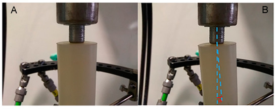 Taylor Spatial Frame Behavior in High Tibial Osteotomies: A Clinical ...