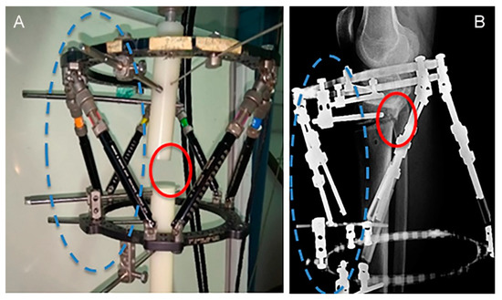 Taylor Spatial Frame Behavior in High Tibial Osteotomies: A Clinical ...