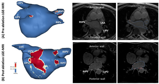 Impact of LGE-MRI in Arrhythmia Ablation