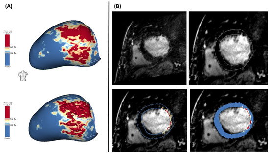 Impact of LGE-MRI in Arrhythmia Ablation