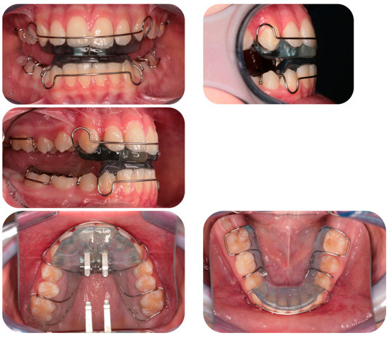 Applied Sciences | Free Full-Text | 3D Evaluation of Upper Airway ...