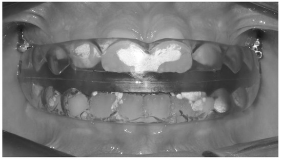 Patient and Parental Satisfaction following Orthodontic Treatment with ...