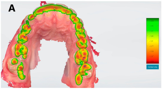 Digital Occlusion Analysis after Orthodontic Treatment: Capabilities of the Intraoral Scanner ...