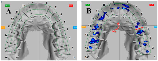 Digital Occlusion Analysis after Orthodontic Treatment: Capabilities of the Intraoral Scanner ...
