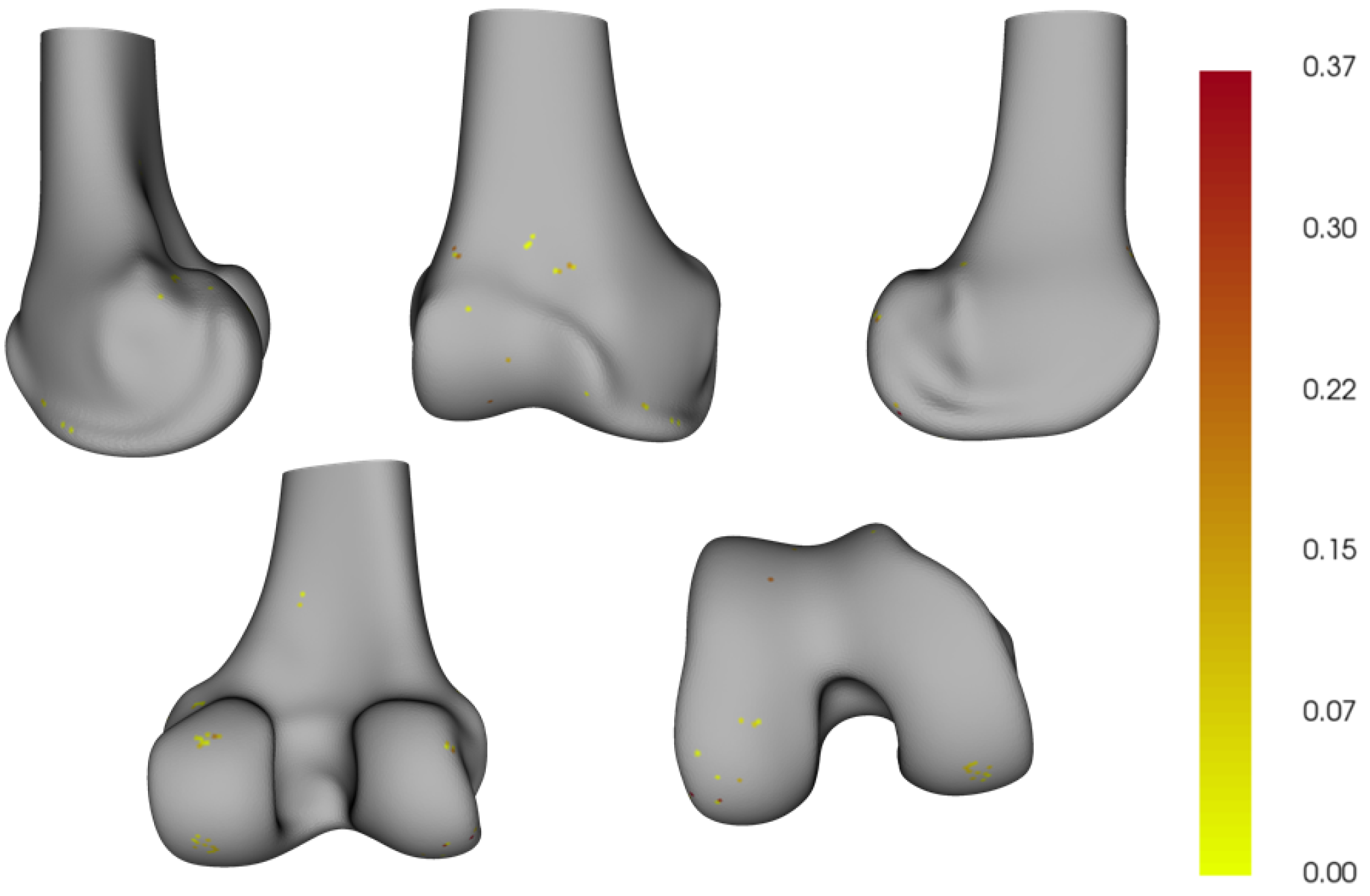Preoperative Prediction of Optimal Femoral Implant Size by Regularized Regression on 3D Femoral ...