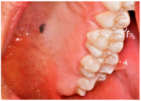A Case Series on Intraoral Blue Nevi with a Literature Review-Based ...
