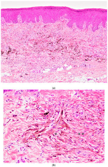 A Case Series on Intraoral Blue Nevi with a Literature Review-Based ...