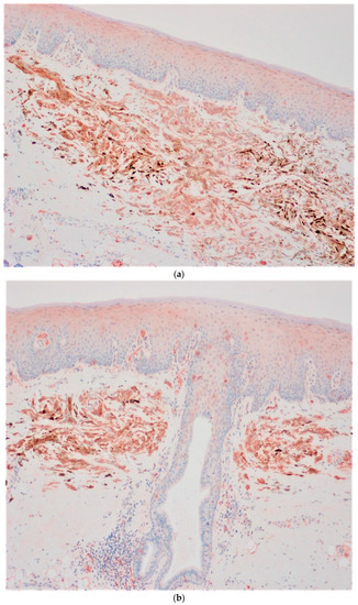 A Case Series on Intraoral Blue Nevi with a Literature Review-Based ...