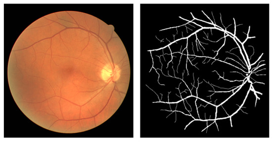Deep Learning Architectures for Diagnosis of Diabetic Retinopathy