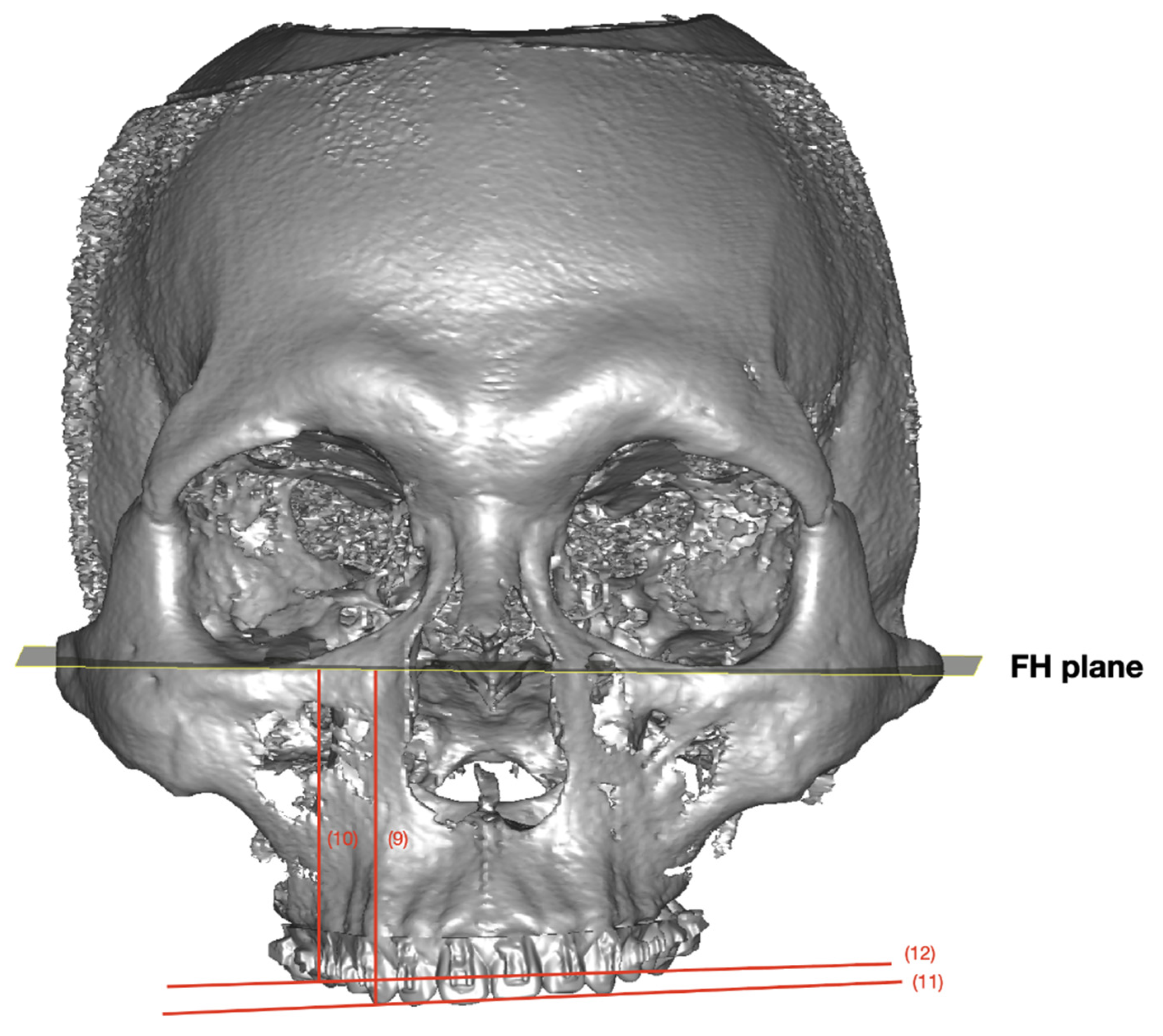 Applied Sciences | Free Full-Text | Preoperative Anatomical Variables Affecting the Outcome of ...