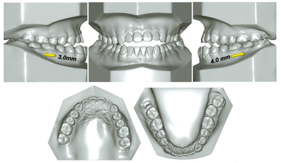 Non-Surgical Camouflage Treatment of a Skeletal Class III Patient with ...