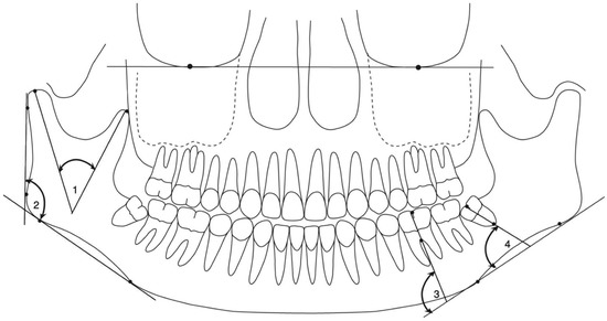 Prediction of Mandibular Third Molar Impaction Using Linear and Angular ...