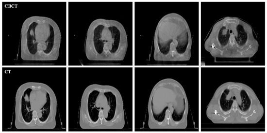 Adaptive Visual Saliency Feature Enhancement of CBCT for Image-Guided ...