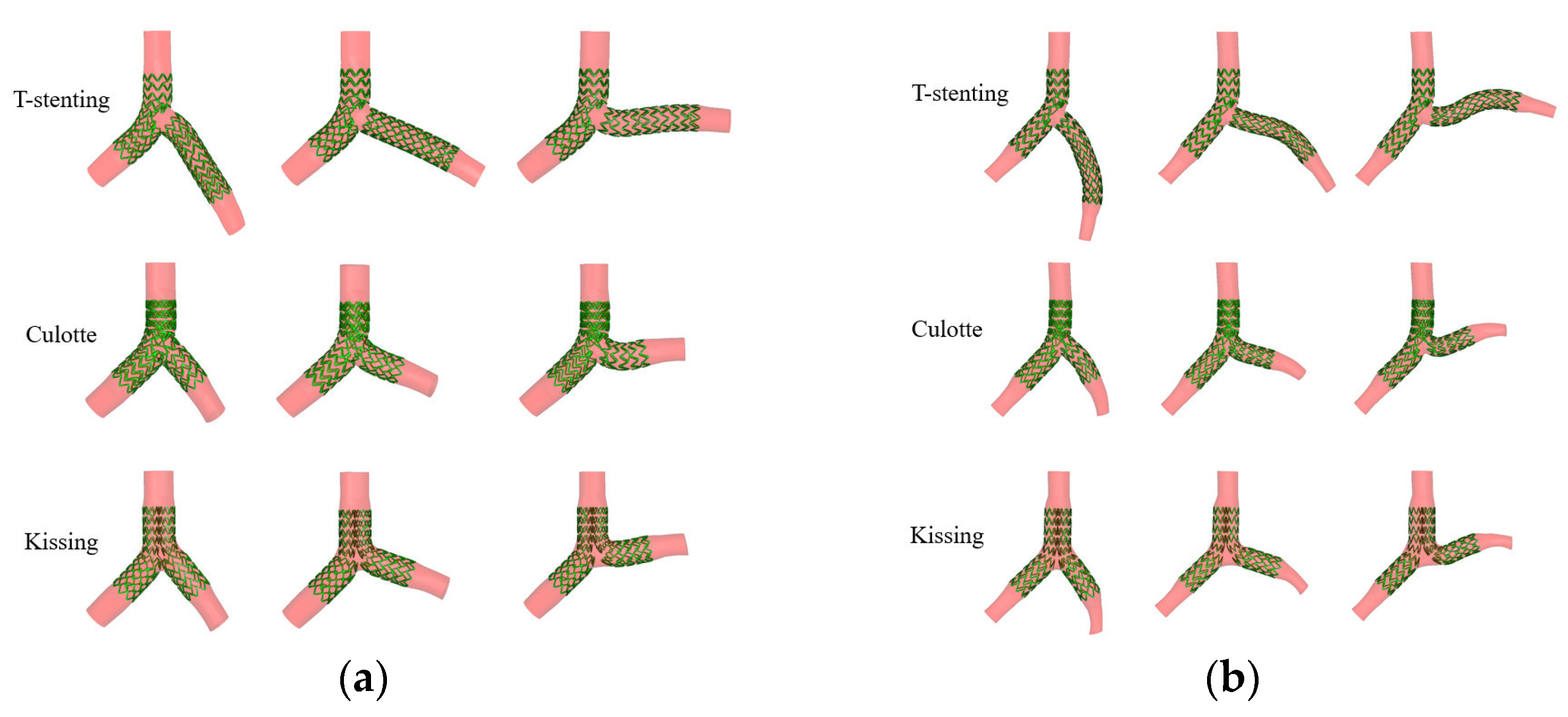 Restenosis Investigation of Two-Stent Placement in the Artery Bifurcation with Different ...