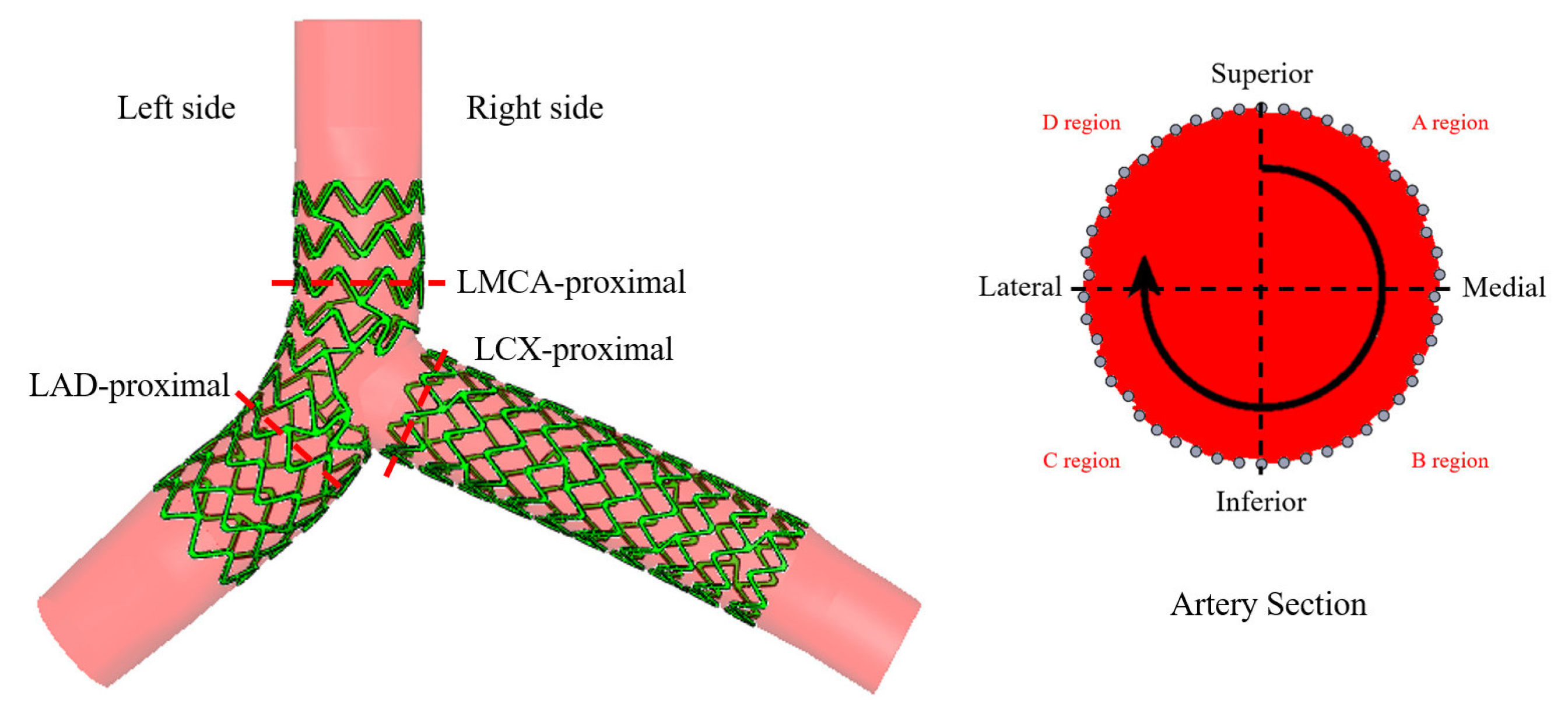 Restenosis Investigation of Two-Stent Placement in the Artery Bifurcation with Different ...
