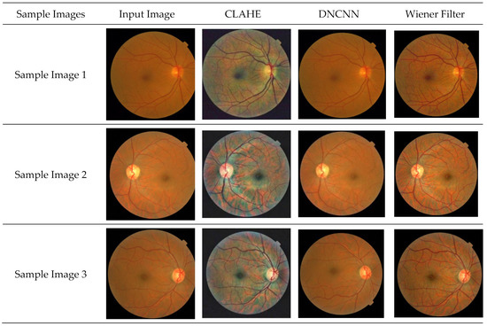 Automatic Detection of Diabetic Hypertensive Retinopathy in Fundus ...