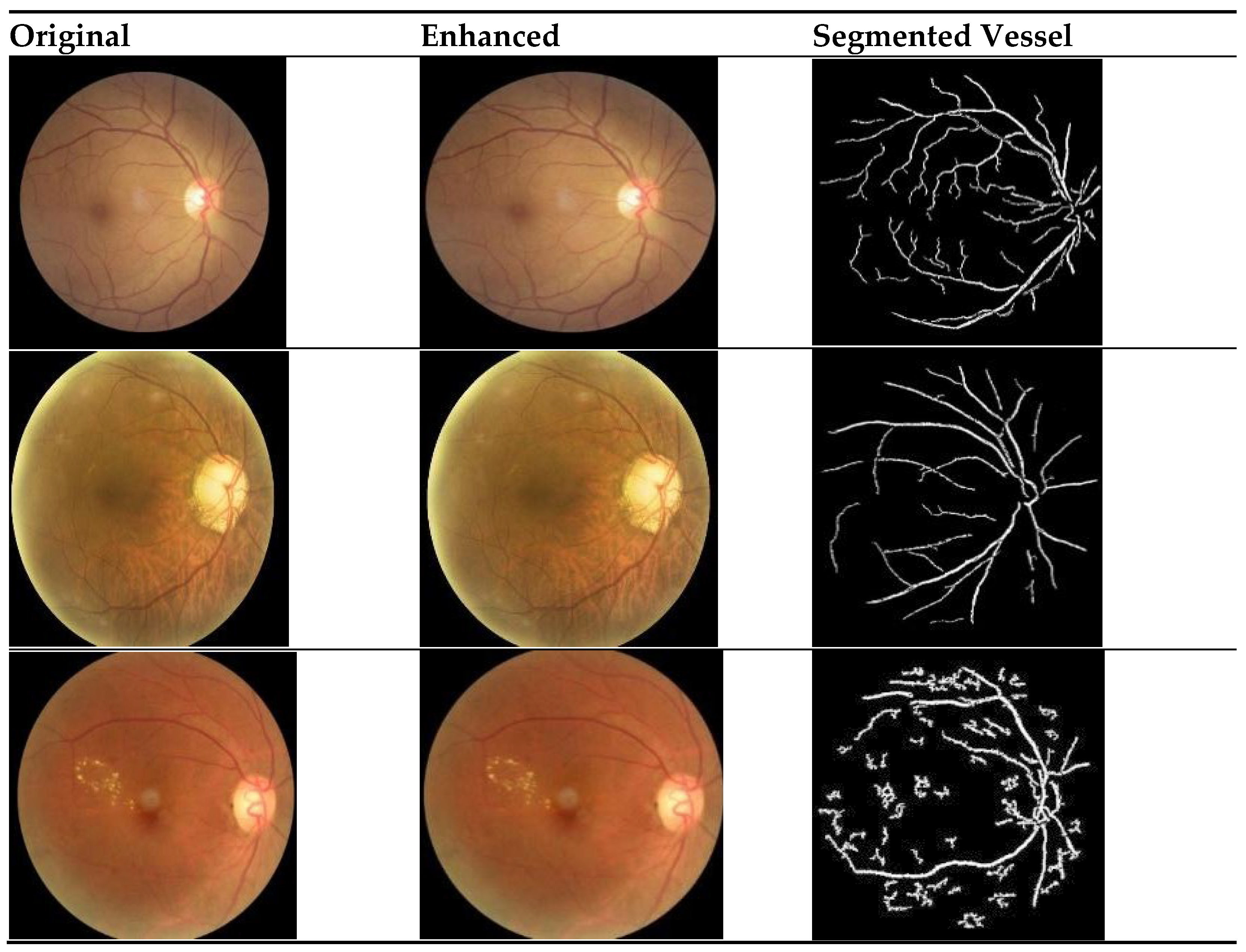 Automatic Detection of Diabetic Hypertensive Retinopathy in Fundus ...