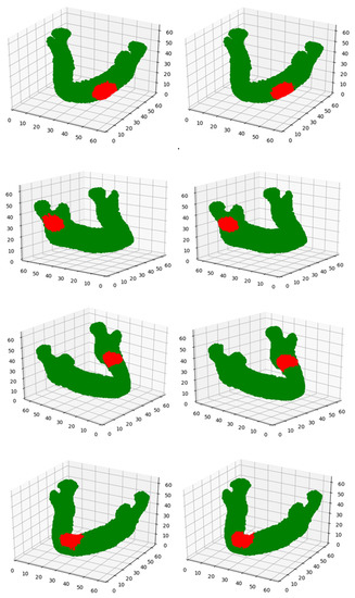 Implant Model Generation Method for Mandibular Defect Based on Improved ...