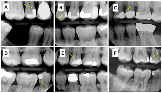 Prevalence and Characteristics of Radiographic Radiolucencies ...