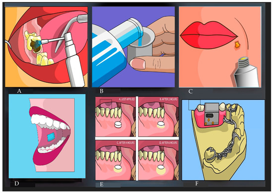 Oral Health and Use of Novel Transbuccal Drug Delivery Systems in ...