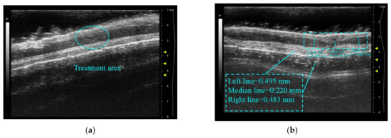 Study of a Novel High-Frequency Ultrasound-Guided Integrated System for ...