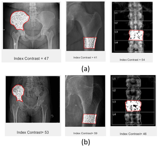 Adopting Signal Processing Technique for Osteoporosis Detection Based ...