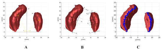 Design of Unilateral Complete Presurgical Nasoalveolar Molding (PNAM ...